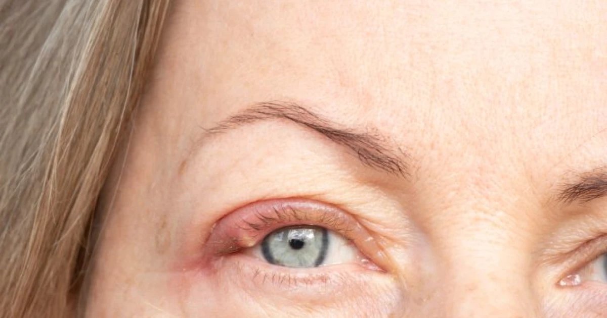 5 soluții rapide pentru ulcior la ochi, pe care le poți încerca acasă ...